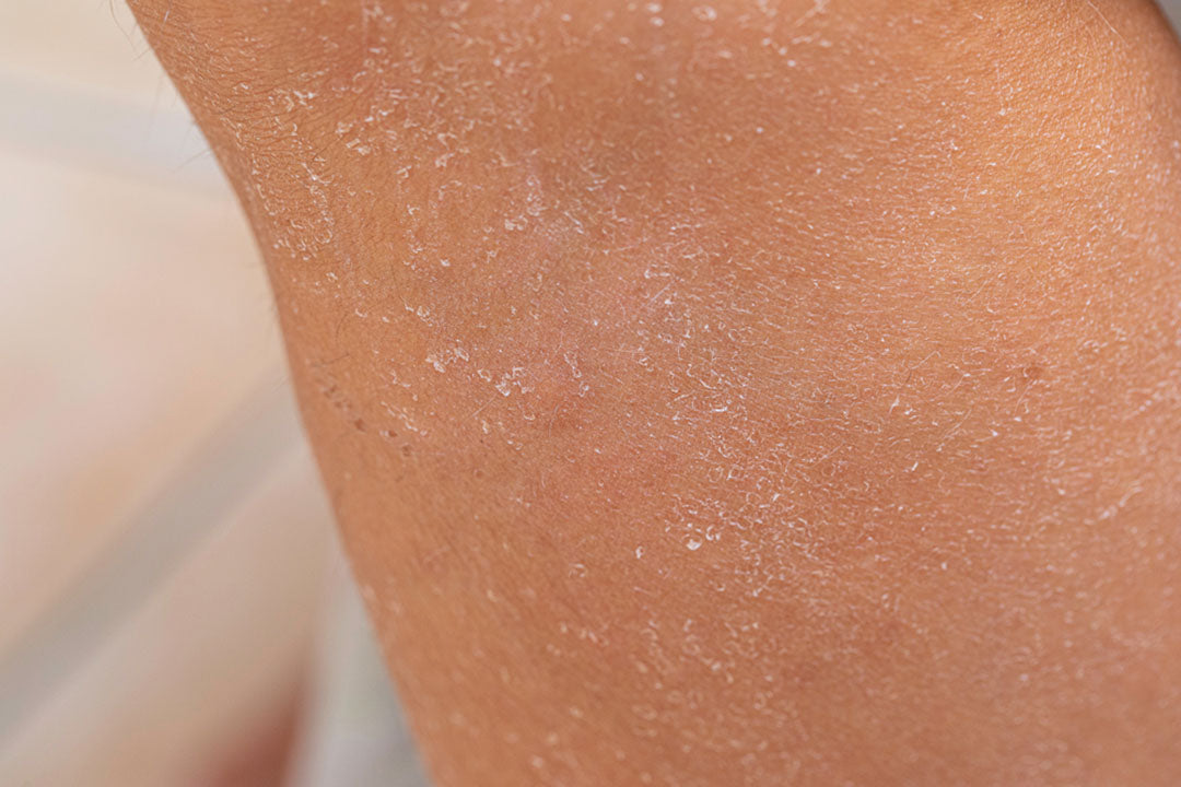 How to Get Rid of Dead Skin Cells from Your Face and Body | Black Wolf